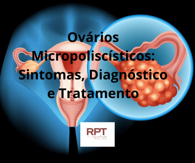 Ovários Micropoliscísticos: Sintomas, Diagnóstico e Tratamento - RPT ...